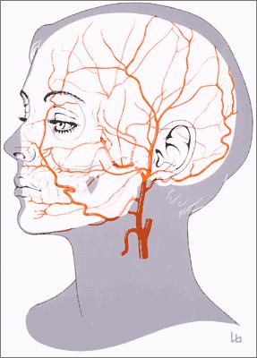 Vernauwing van de halsslagader, schoonmaken van de binnenwand (Folder ...
