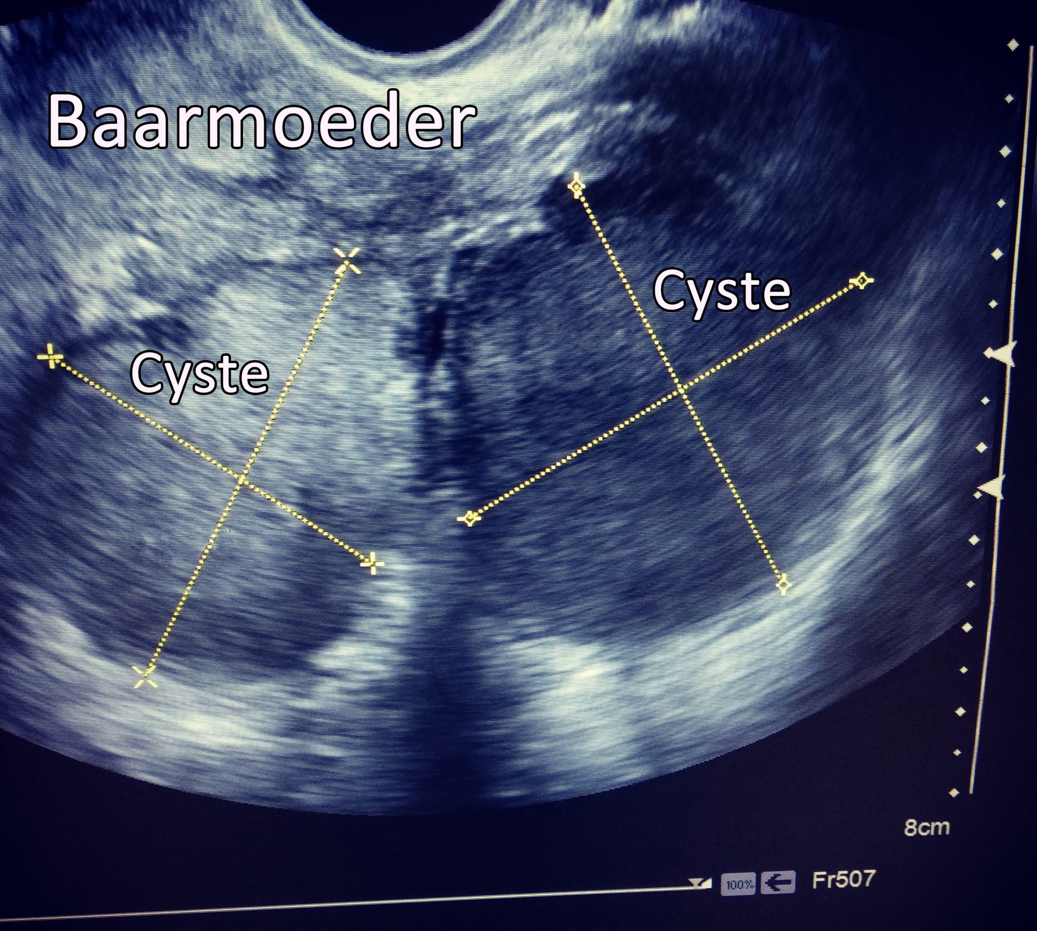 Endometriose (Folder) - Catharina Ziekenhuis