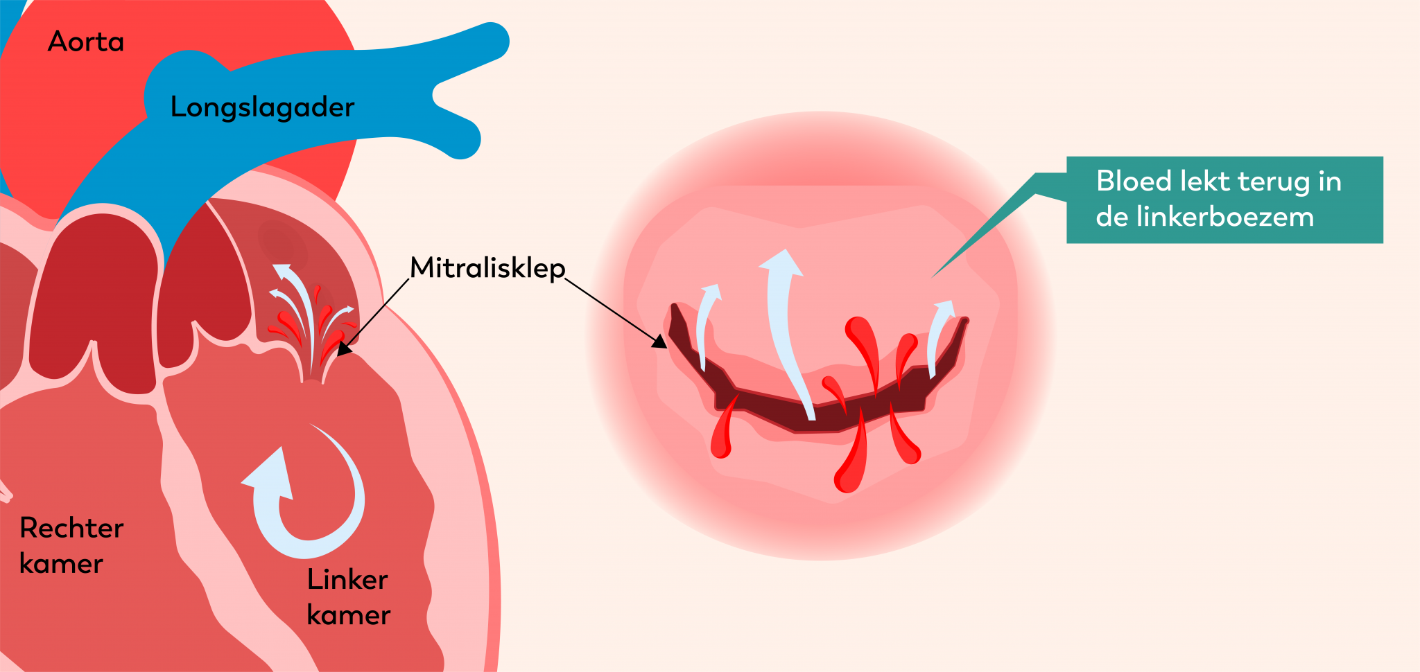 Mitraclip (Folder) - Catharina Ziekenhuis