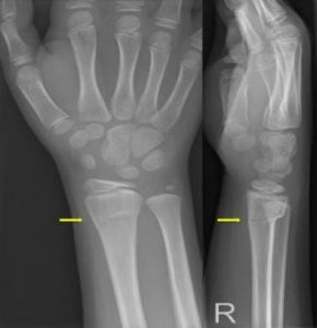 Twijgbreukje in pols bij kinderen (greenstick) (Folder) - Catharina ...