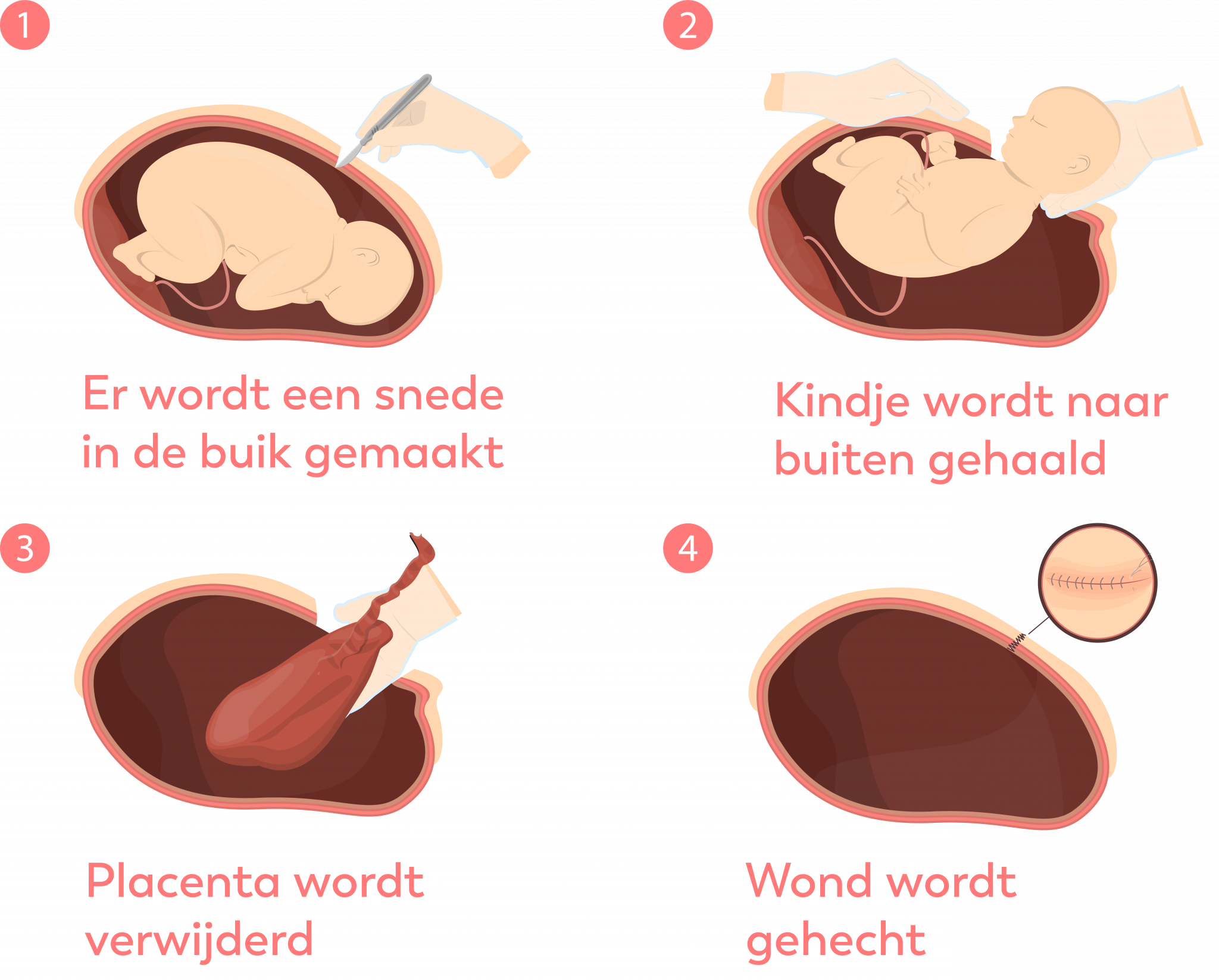 Zorg rondom een keizersnede (Folder) - Catharina Ziekenhuis