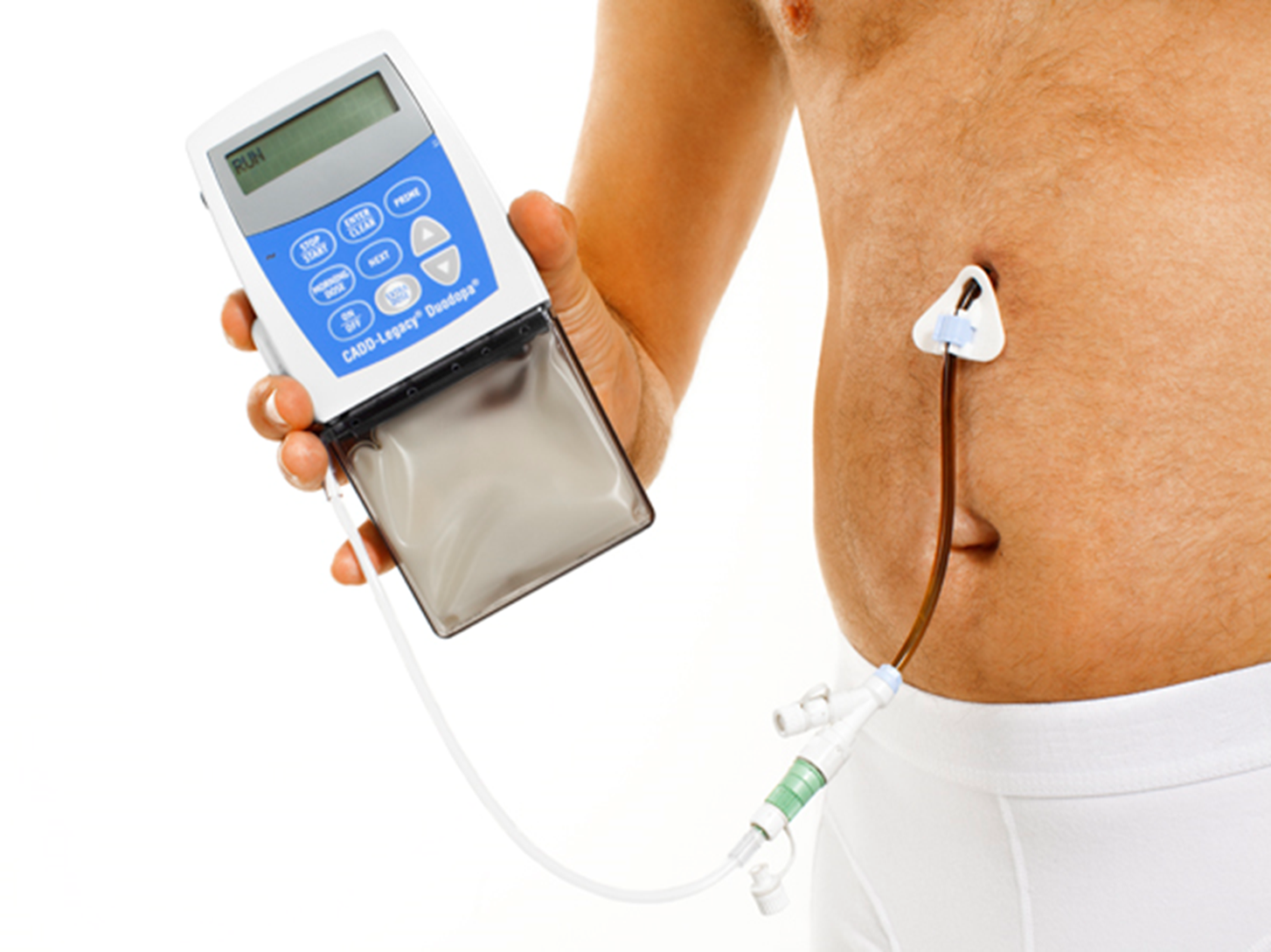 Catharina Ziekenhuis expert in het plaatsen van PEG-sondes - Catharina ...