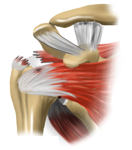 Scheur in de rotatorenmanchet - Catharina Ziekenhuis