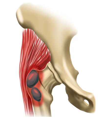 Heup, slijmbeursontsteking - Catharina Ziekenhuis
