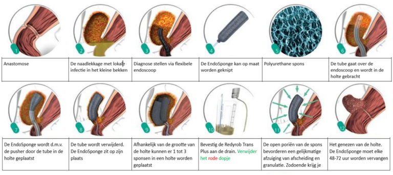 Endo-Sponge® behandeling in de dikke darm (Folder) - Catharina Ziekenhuis