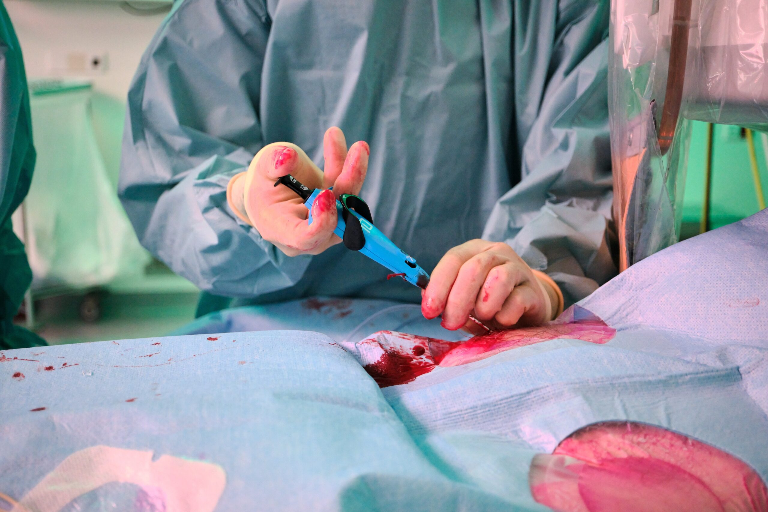 Dit hulpmiddel maakt ablatie comfortabeler voor patiënt: ‘Minder last ...