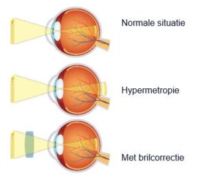Myopie (bijziendheid) (Folder) - Catharina Ziekenhuis