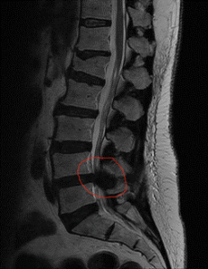 Lumbale kanaalstenose (Folder) - Catharina Ziekenhuis